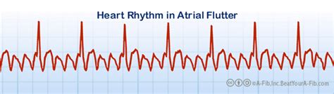 Faq A Fib And The Two Types Of A Flutter Atrial Fibrillation