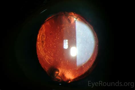 Atlas Entry Polymorphic Amyloid Degeneration Of The Cornea