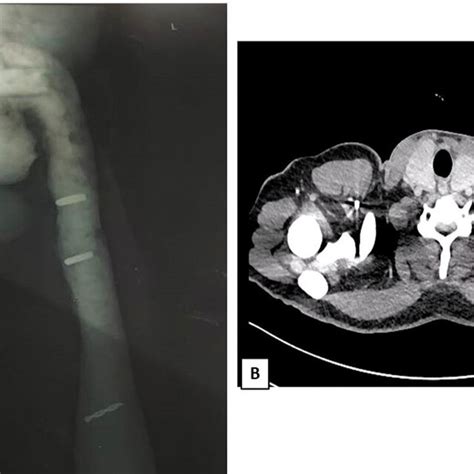 A Diffuse Increase In Bone Density Is Seen Involving The Visualized Download Scientific Diagram