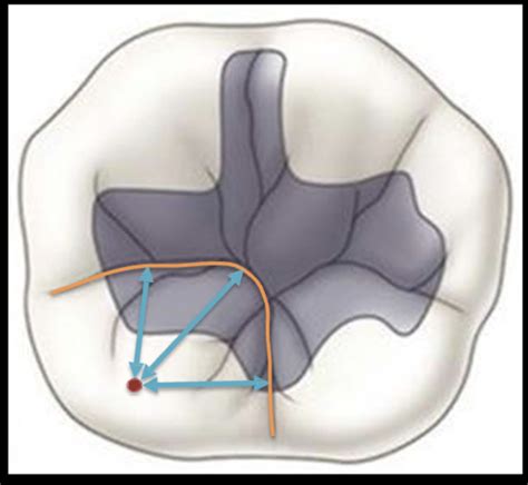 L21 Complex Amalgam Restorations Flashcards Quizlet