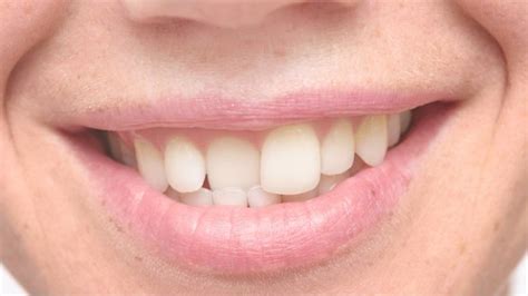 Best Options To Fix A Snaggle Tooth Discover Pros And Cons