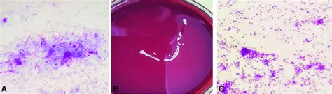 A Direct Gram Smear Showing Beaded Gram Positive Filamentous Bacilli