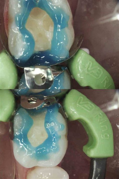 Palodent Matrix System