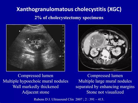 Ultrasound Of Acute And Chronic Cholecystitis Pptx