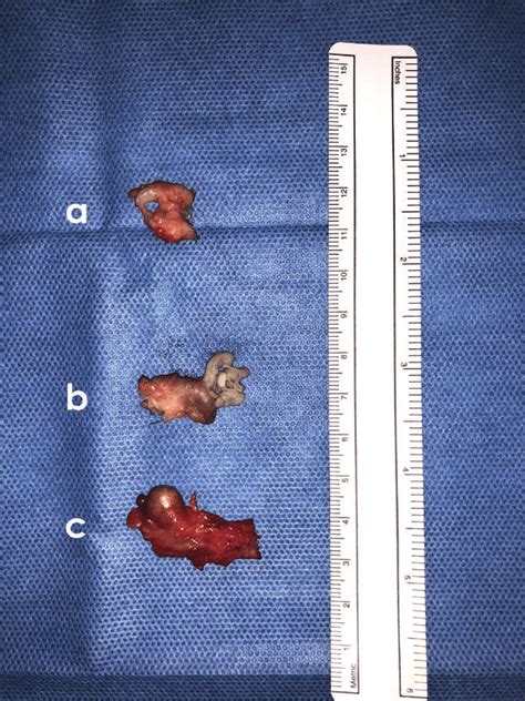 Intraoperative Specimens Following Excision A Nodule Cord Excision Download Scientific