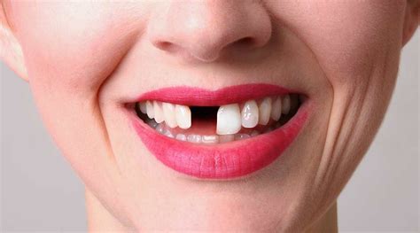 What Can You Do About Missing Teeth Smile Denture And Implant Clinic