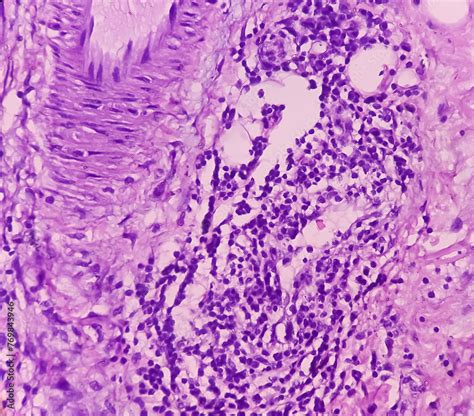 Inguinal Lymph Node Excised Lymphoproliferative Disorder Lpd Section Show Lymph Node