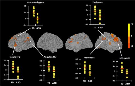 Significant Clusters Of Between Group Differences Td Asd For The Download Scientific