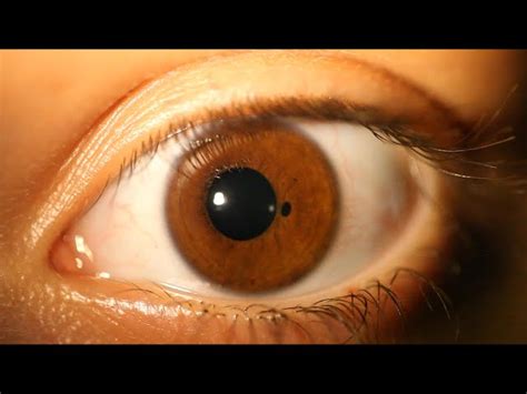 Split Pupil Syndrome Urrets Zavalia Syndrome After Implantable