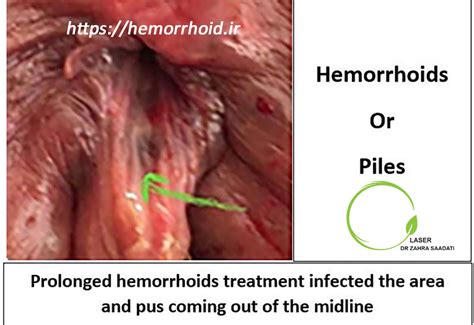 Non Thrombosed External Hemorrhoids