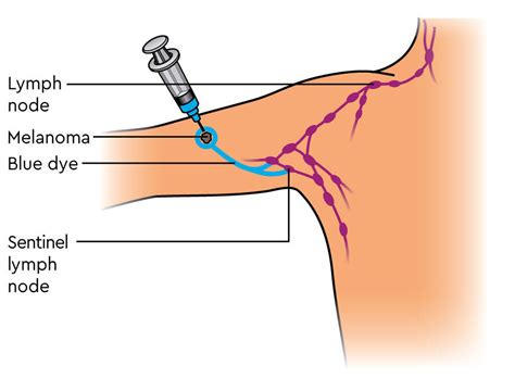 Why Remove Lymph Nodes