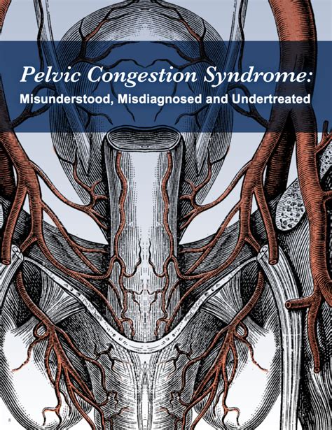 Common Causes Of Pelvic Congestion Syndrome Miami Vein Center Hot Sex