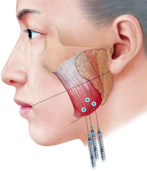 The Botulinum Toxin Injection Into The Masseter Muscle Was Administered Download Scientific