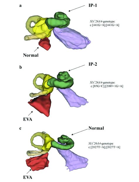 A 3D Reconstruction Of The Incomplete Partitions Of The Cochlea And