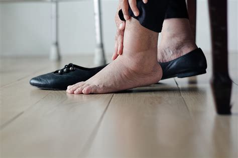 Picioare Umflate Cauze Simptome Si Metode De Tratament Reginamaria Ro