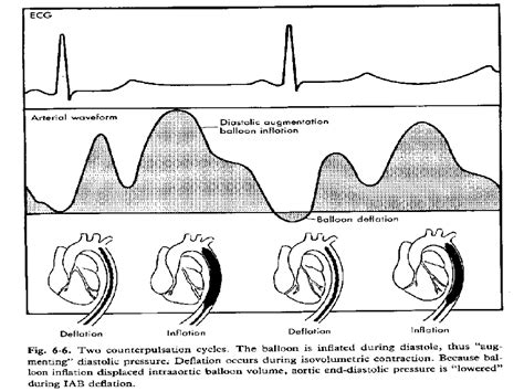 Iabp Principle Hemodynamic Timing Weaning 2016 Background Asmiha