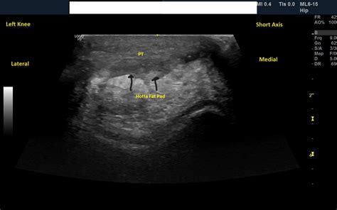 Patellar Tendon Rupture