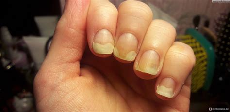 Онихолизис Ногтей Что Такое На Ногтях Фото —