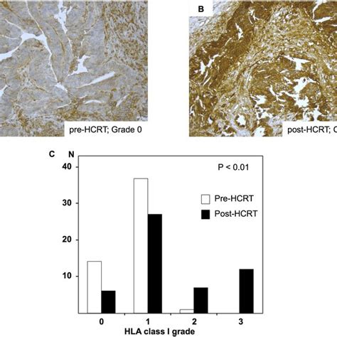 Changes In Human Leukocyte Antigen HLA Class I Expression After Download Scientific Diagram