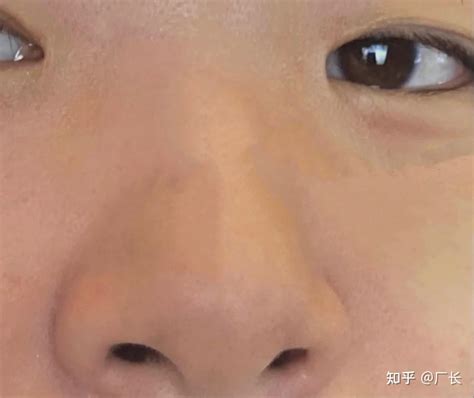 男生鼻子黑头太多，摸起来一粒一粒的，看着恶心巨丑！有什么靠谱好用的去黑头方法？ 知乎