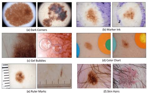 An Overview Of Melanoma Detection In Dermoscopy Images Using Image Processing And Machine Learning