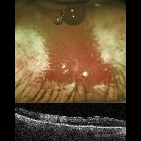 Retina Rocks Acute Retinal Necrosis Syndrome Following