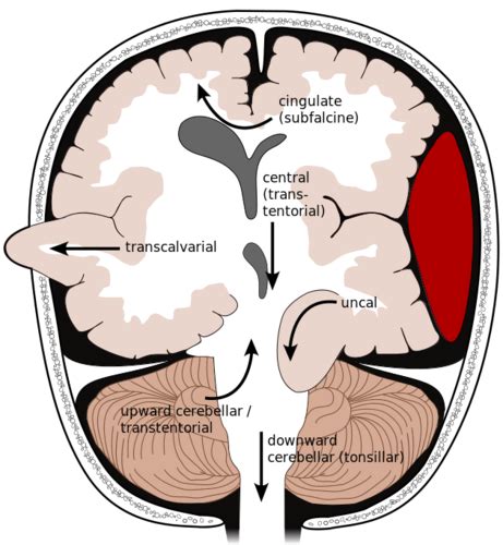 Central Herniation