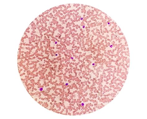 Premium Photo Photomicrograph Of Hematological Slide Showing Monocytosis Abnormal Monocyte