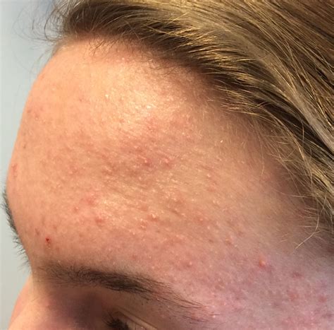 Redditor With Fungal Acne Shares Her Dramatic Before And After Photos