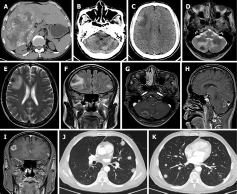 Male Age 52 Years Han Chinese A Abdominal Computed Tomography Ct Download Scientific