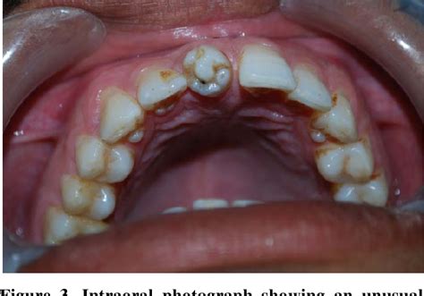 Figure 3 From Multiple Talon Cusps On Maxillary Central Incisor A Case