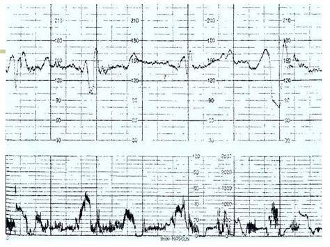 Cardiotocography Ctg Ppt