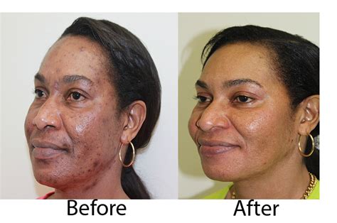 Post Laser Hyperpigmentation Melasma Dark Skin 48 Off