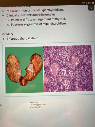 Endocrine Patho Flashcards Quizlet