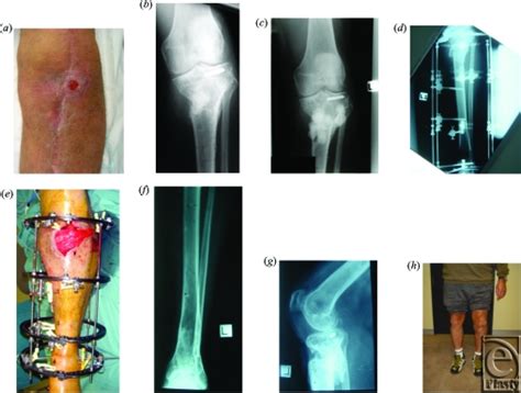 Aggressive Management Of Tibial Osteomyelitis Shows Good Functional Outcomes Pmc