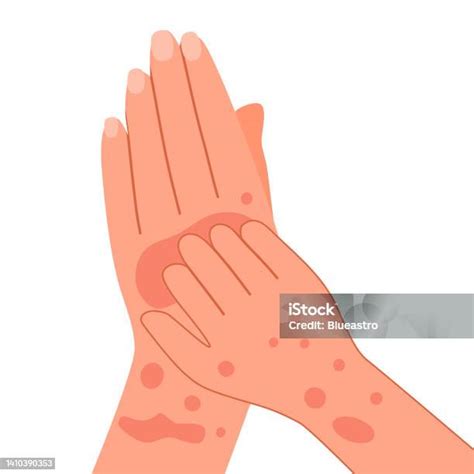 손과 팔 개념을 긁는 것 강한 알레르기로 고통받는 여성은 평평한 디자인으로 가려운 피부 가려운 증상입니다 붉은 발진 피부 자극 원숭이 두 건강관리와 의술에 대한 스톡 벡터