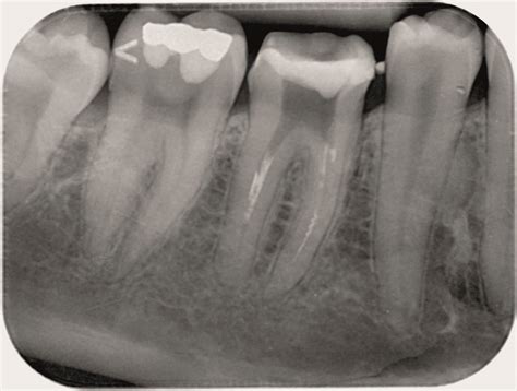 Dental News Orthograde Apical Application Of An Mta Plug In A Tooth
