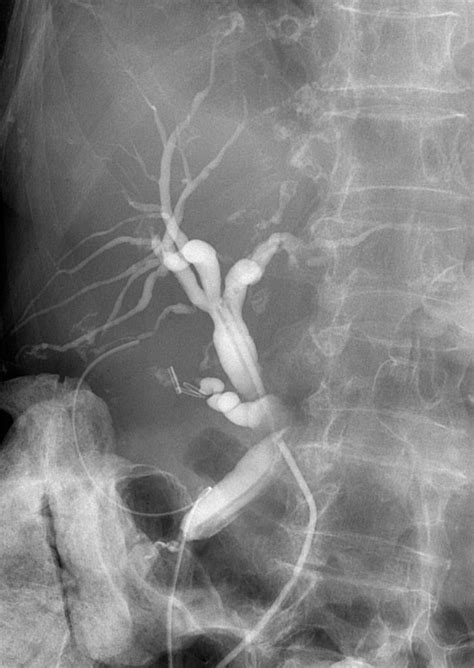 T Tube Cholangiogram