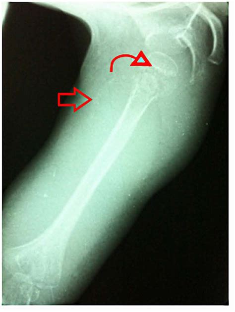 Radiograph Of Right Shoulder Shows Dense Linear Calcification In The
