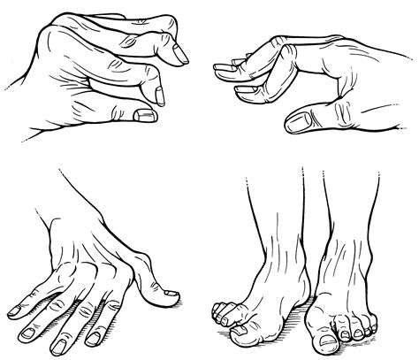 Rheumaknowledgy Rheumatoid Arthritis