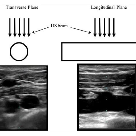 PICC Tip Termination Using 3CG ECG Technology Download Scientific Diagram