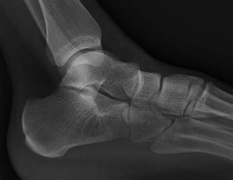 Chopart Dislocation The Bone School