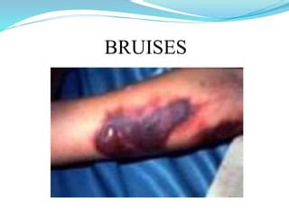 Dengue Fever Ppt
