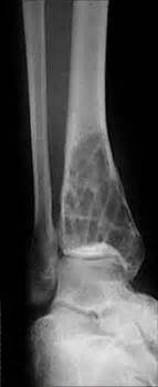 Fibrosarcoma Of Bone Pathology Orthobullets