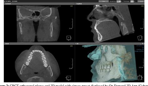 Figure 2 From Evaluation Of The Role Of Cone Beam Computed Tomography As An Adjunctive