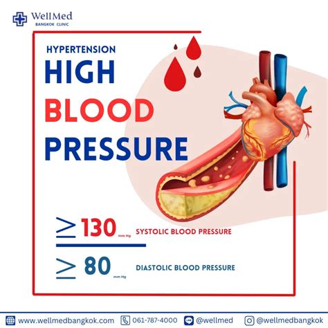 고혈압hypertension Wellmed 베스트 방콕 클리닉 2025 고혈압hypertension Wellmed 베스트 방콕 클리닉 2025