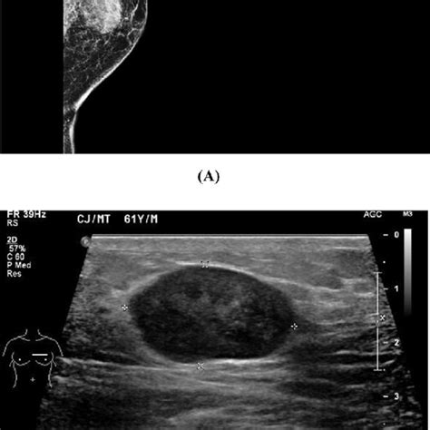 A Mammography Of Left Breast Shows A Well Defined Oval Shaped
