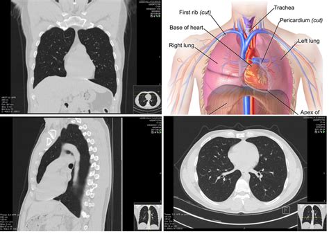 Automatic Interpretation Of Chest Ct Scans With Machine Learning Glass Box