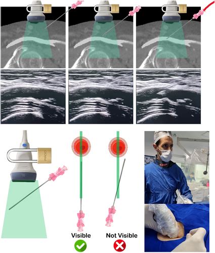 A Six‐step Approach For Optimizing Ultrasound‐guided Femoral Artery