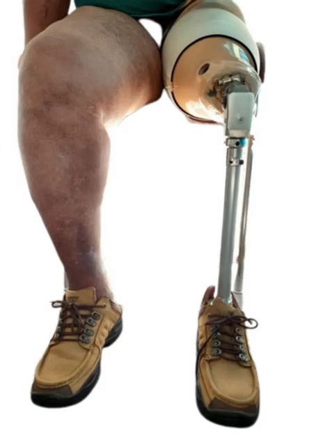 passive prosthetic manual locking above knee prosthesis myoelectric at rs 70000 in secunderabad
